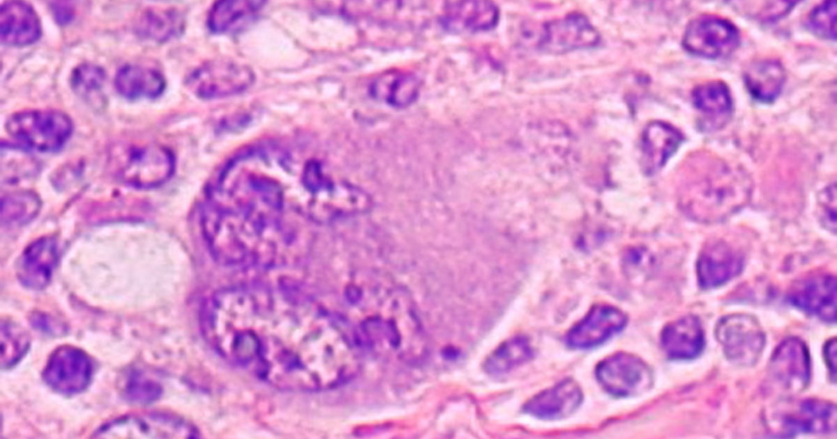 Newsletter 1/2013 | Hodgkinův lymfom